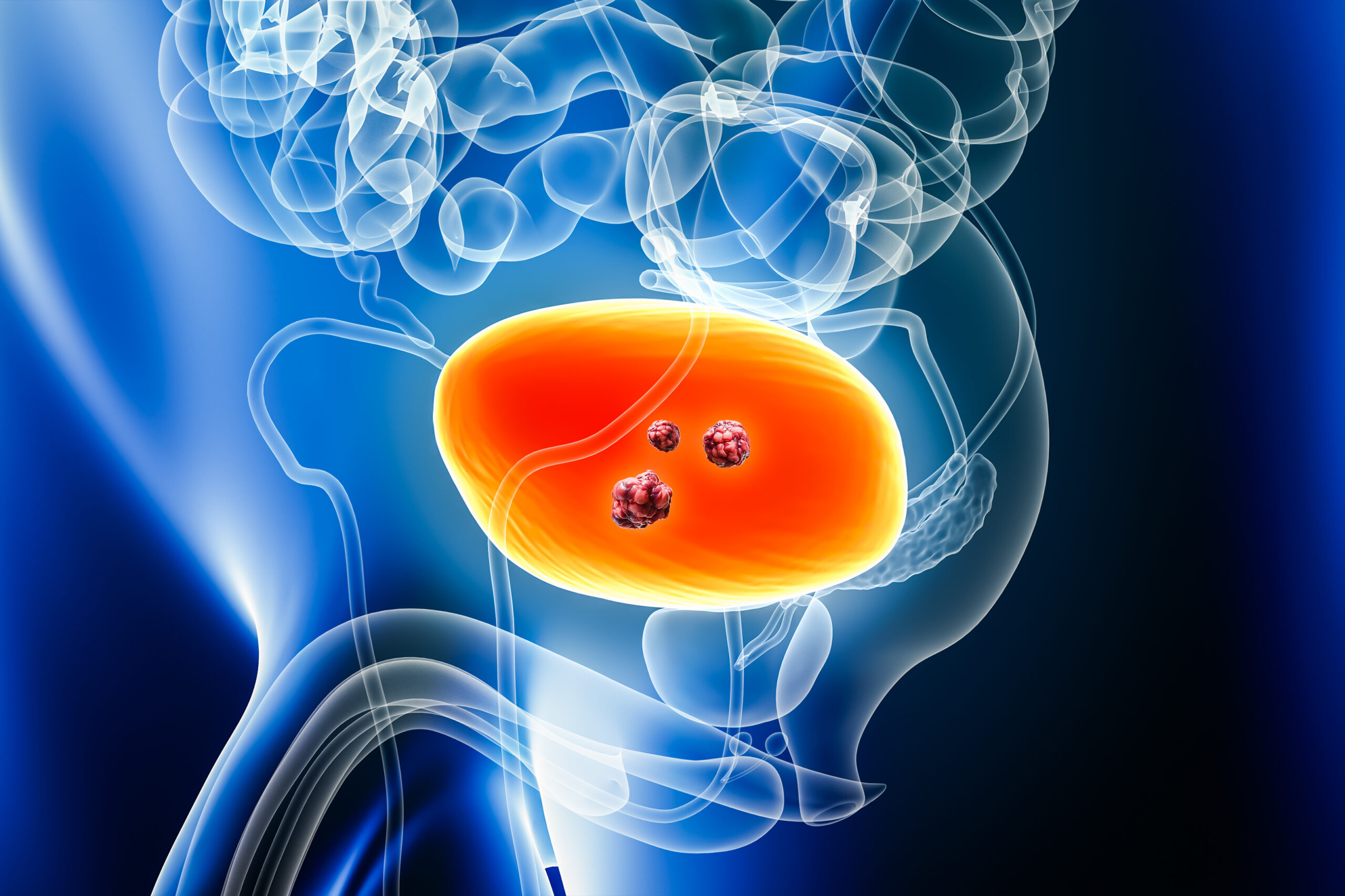 Detection Of Circulating Tumour Cells In Urothelial Cancers And